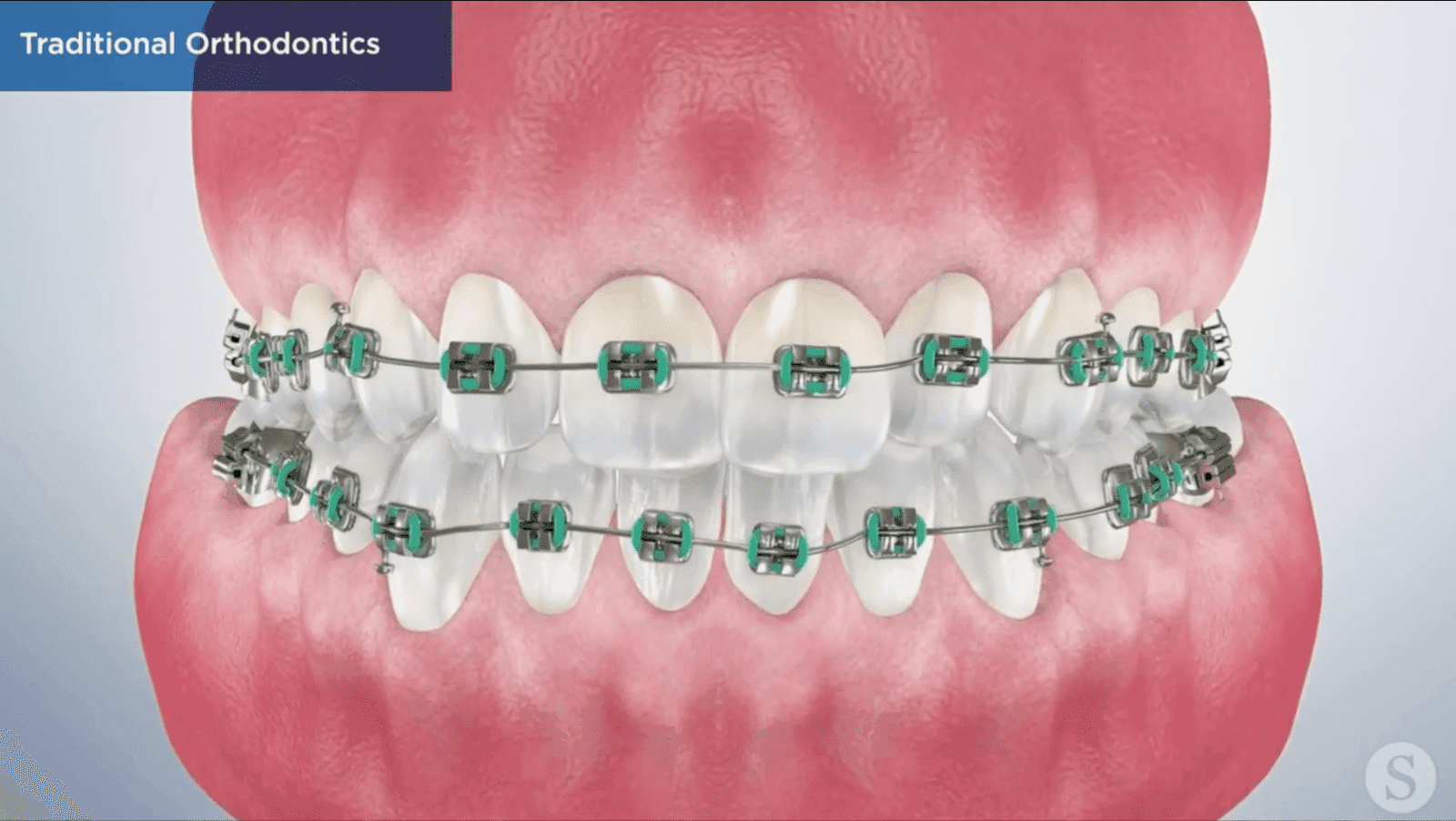 Braces in Phoenix - Trusmile Now