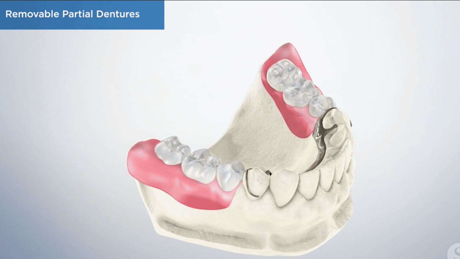 Partial Dentures in Phoenix - Trusmile Now